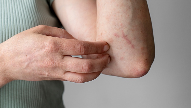 What to Do If You Have Recurrent Fungal Infections?